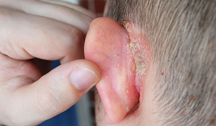 What You Need To Know About That Lump Behind Your Ear